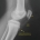 Doença de Osgood-Schlatter - Ortopedista Oncológica